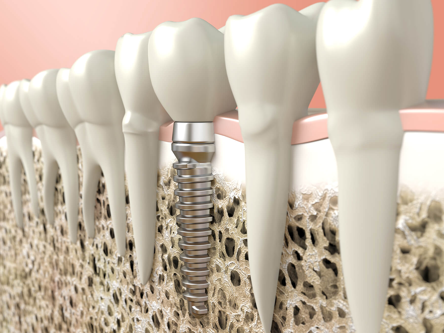 The effect of inadequate access to peri‐implant hygiene on marginal ...