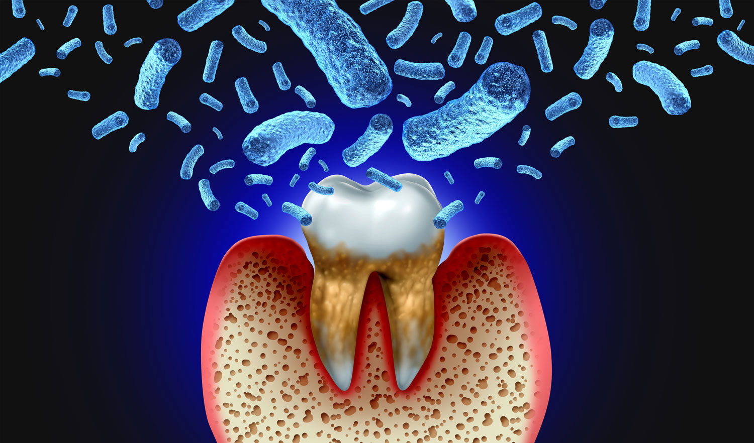 Periodontal disease: A systemic condition – ODHA Dental Hygiene Newswire